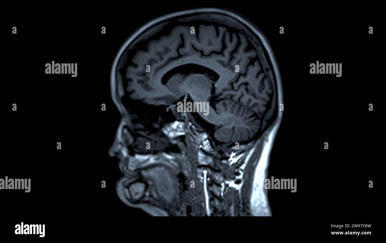 MRI brain scans sagittal view offer valuable insights into brain ...
