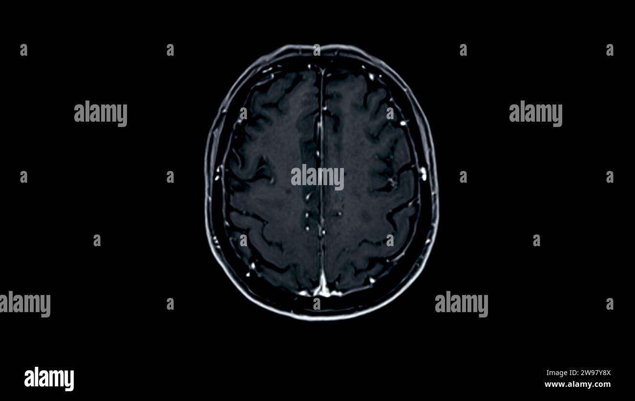 MRI brain scans axial view offer valuable insights into brain anatomy ...