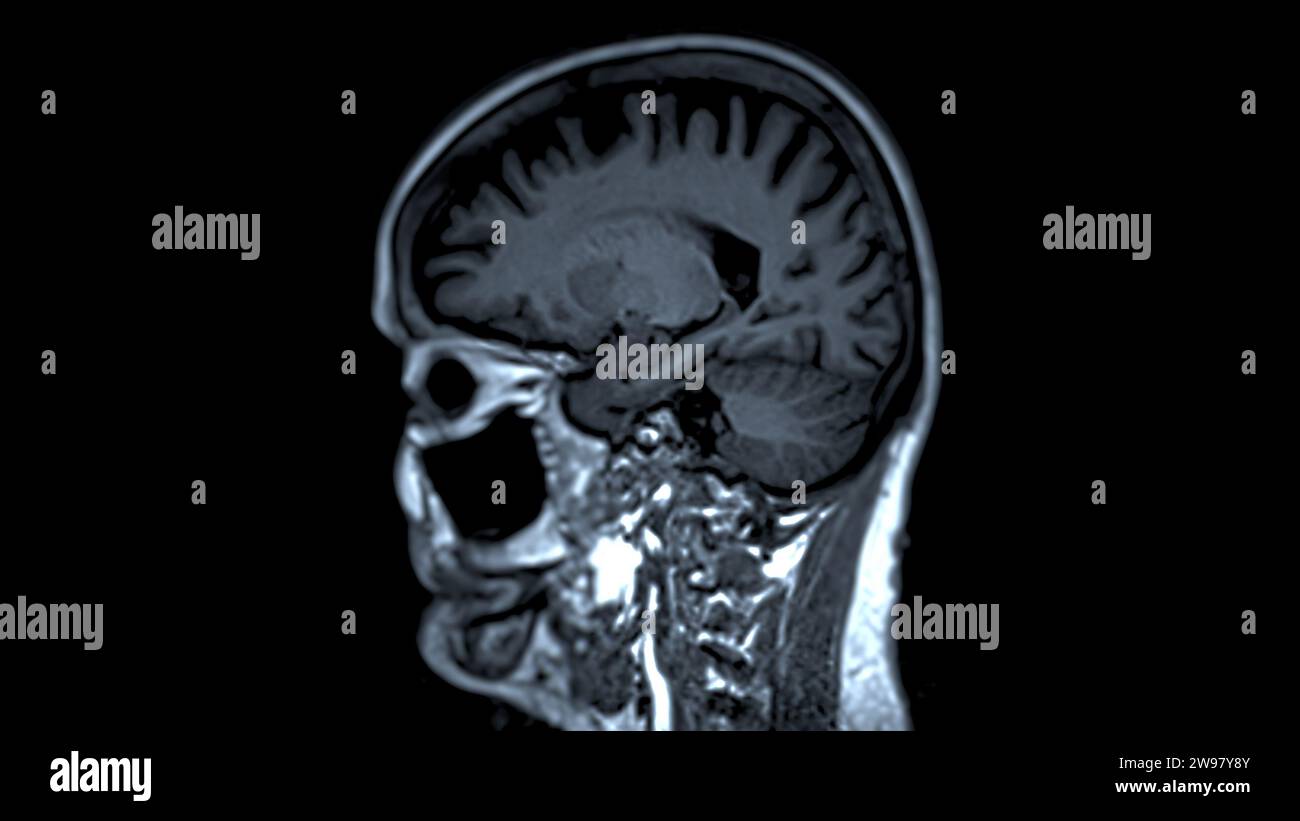 MRI brain scans sagittal view offer valuable insights into brain ...