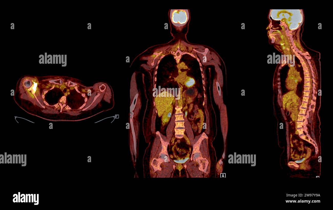 PET CT Scan fusion image It provides detailed images by merging ...