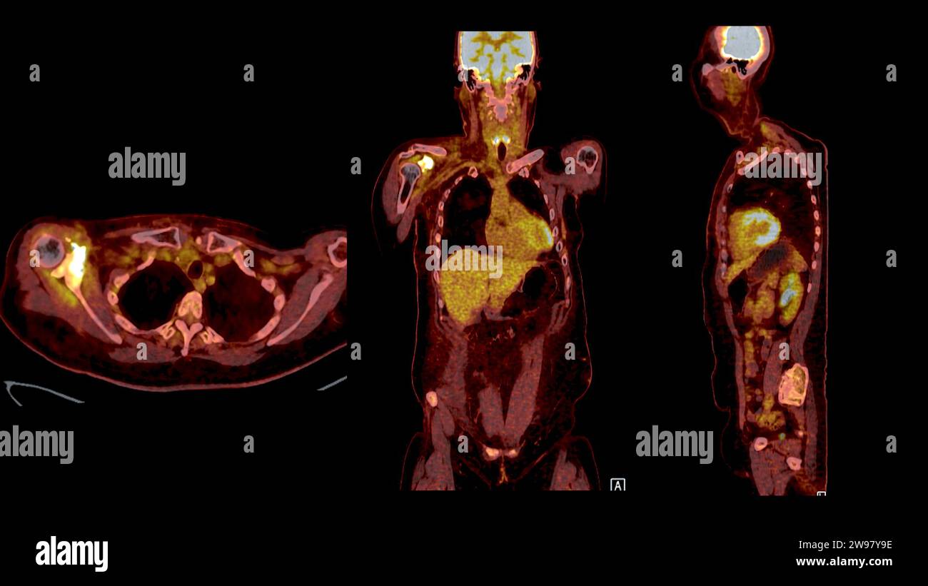 PET CT Scan fusion image It provides detailed images by merging ...