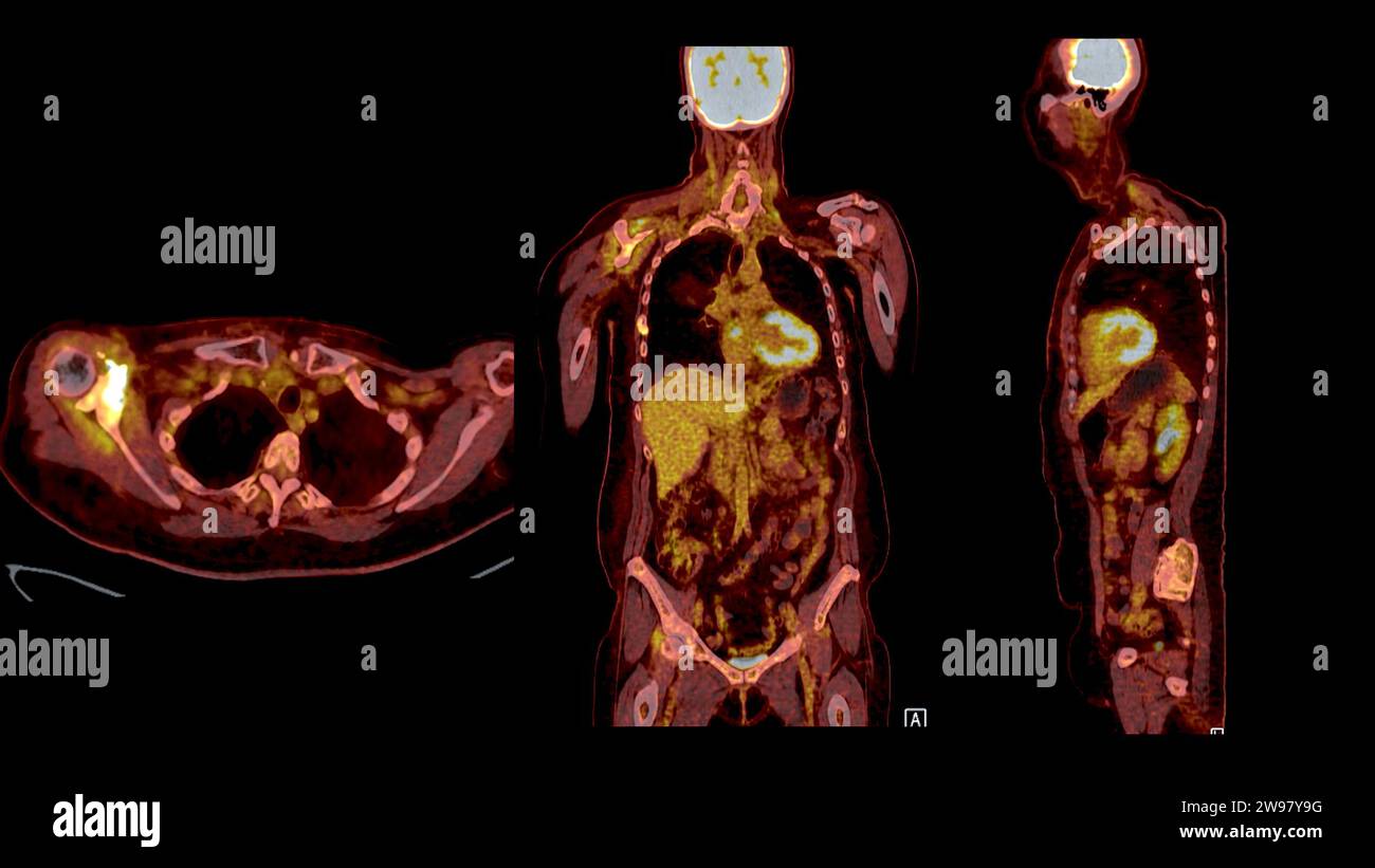 PET CT Scan fusion image It provides detailed images by merging ...