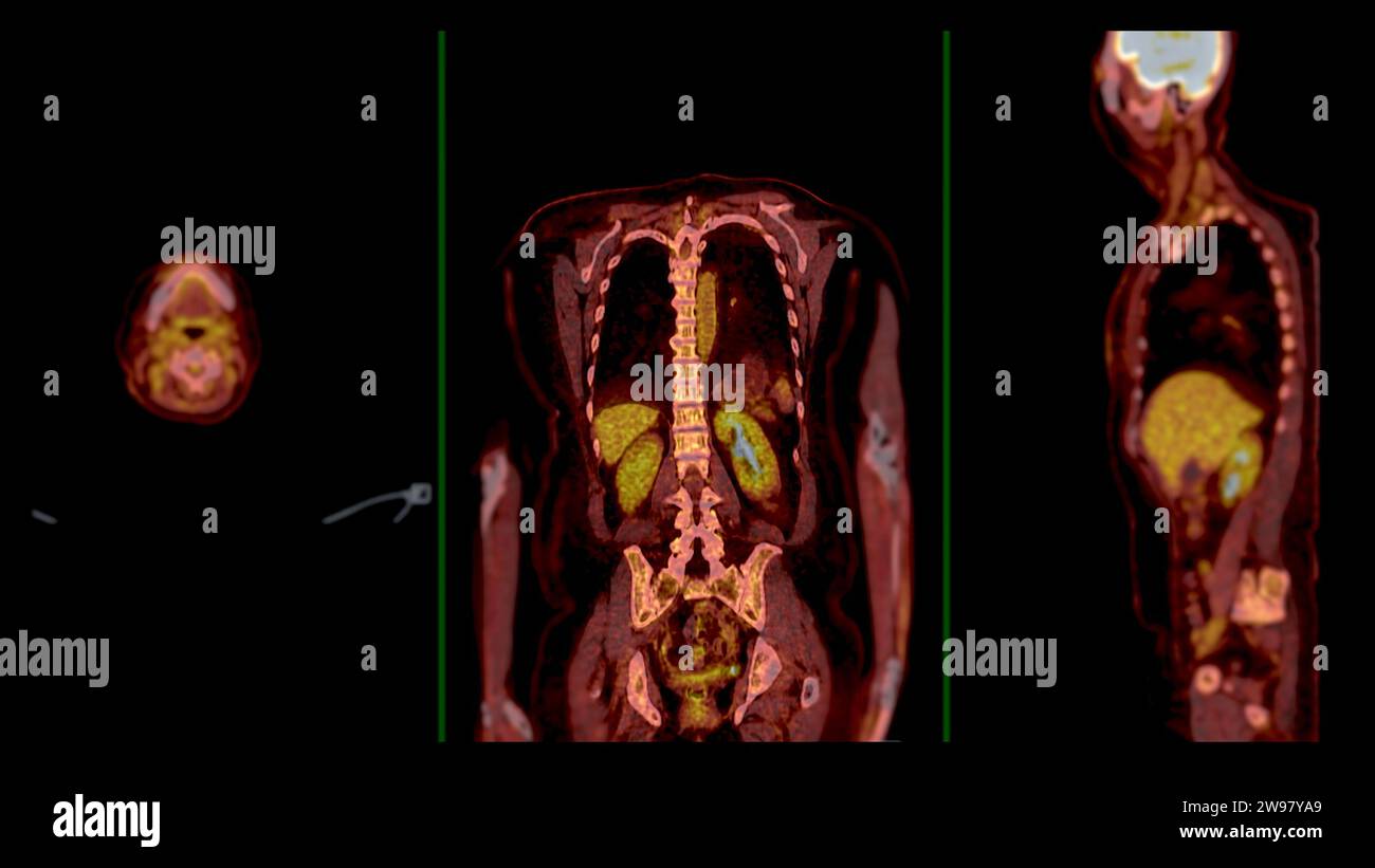 PET CT Scan fusion image It provides detailed images by merging ...