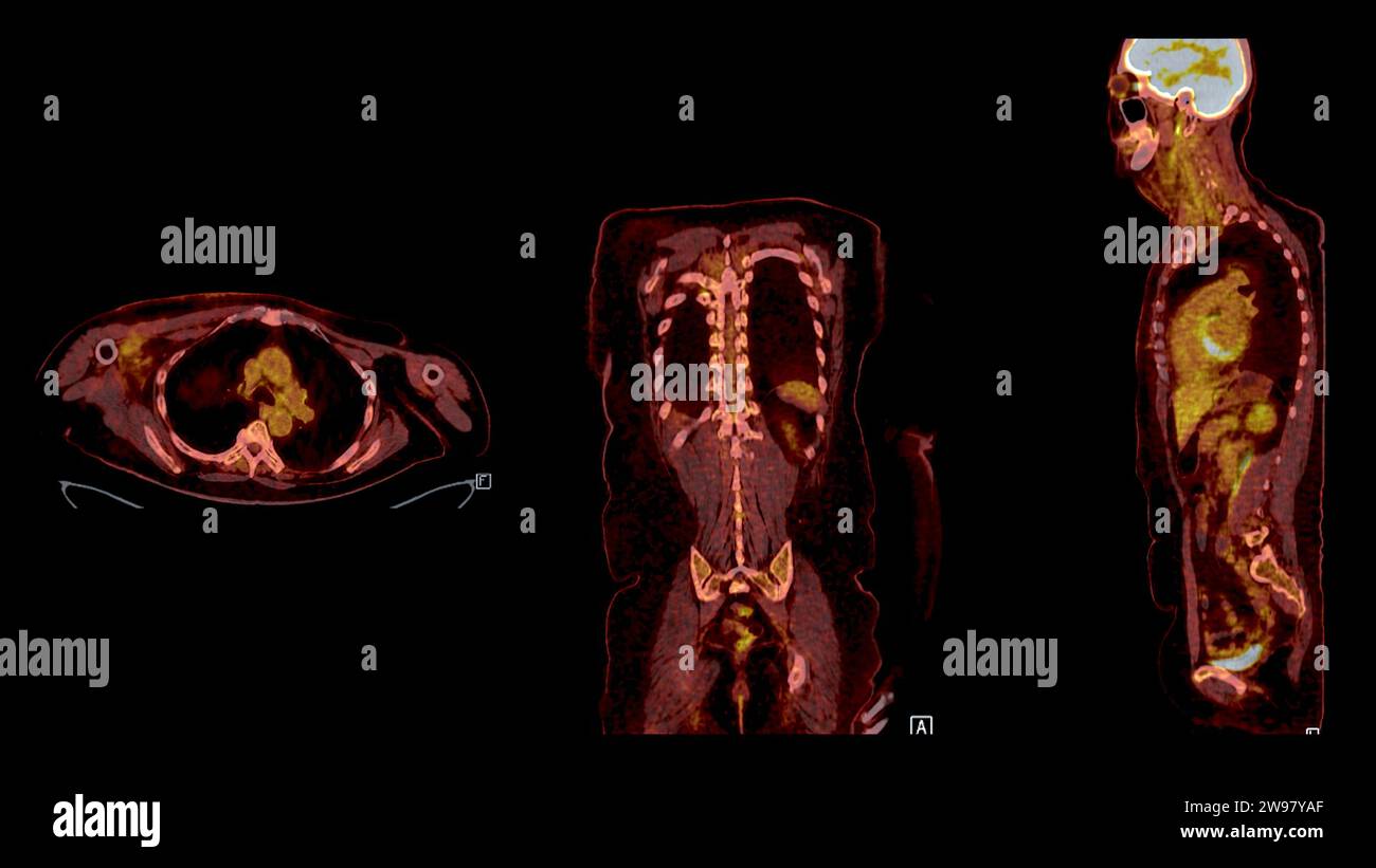 PET CT Scan fusion image It provides detailed images by merging ...