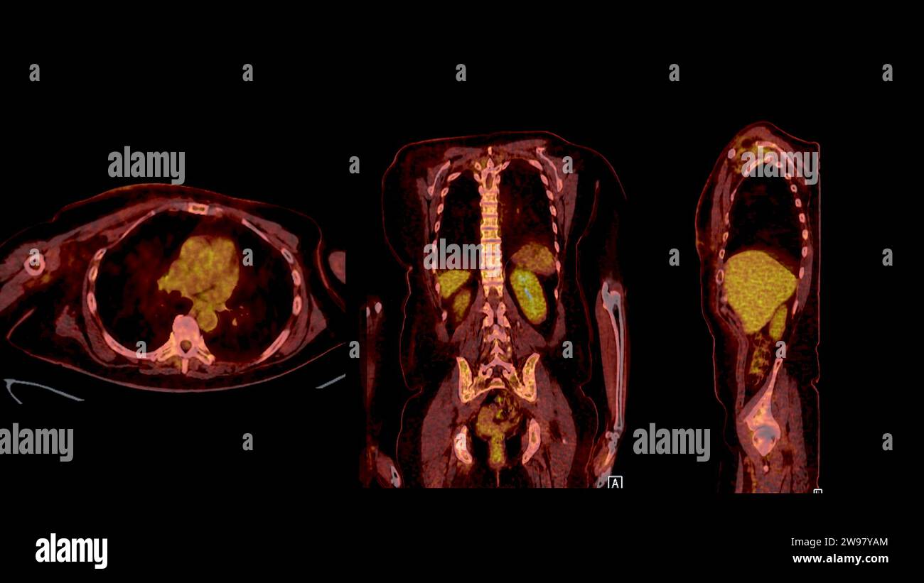 PET CT Scan fusion image It provides detailed images by merging ...
