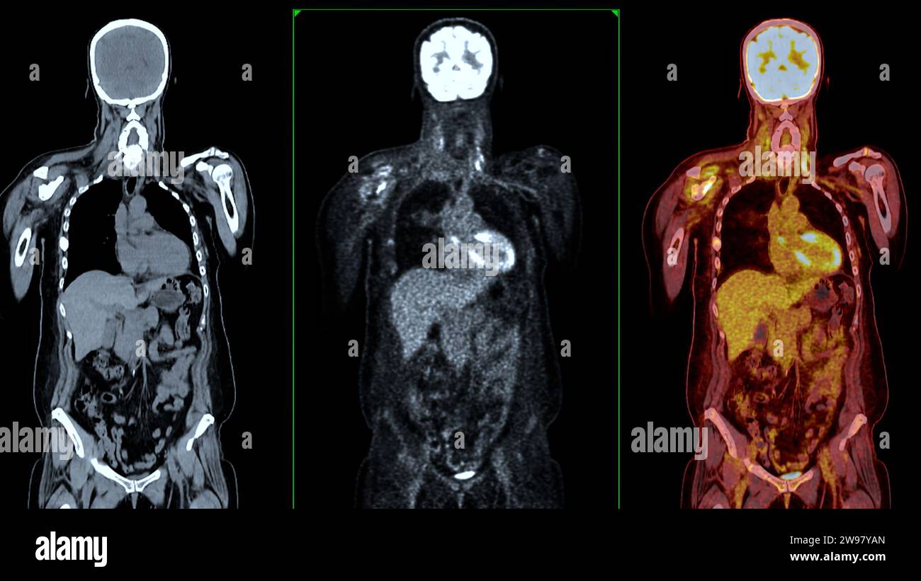 PET CT Scan fusion image It provides detailed images by merging ...