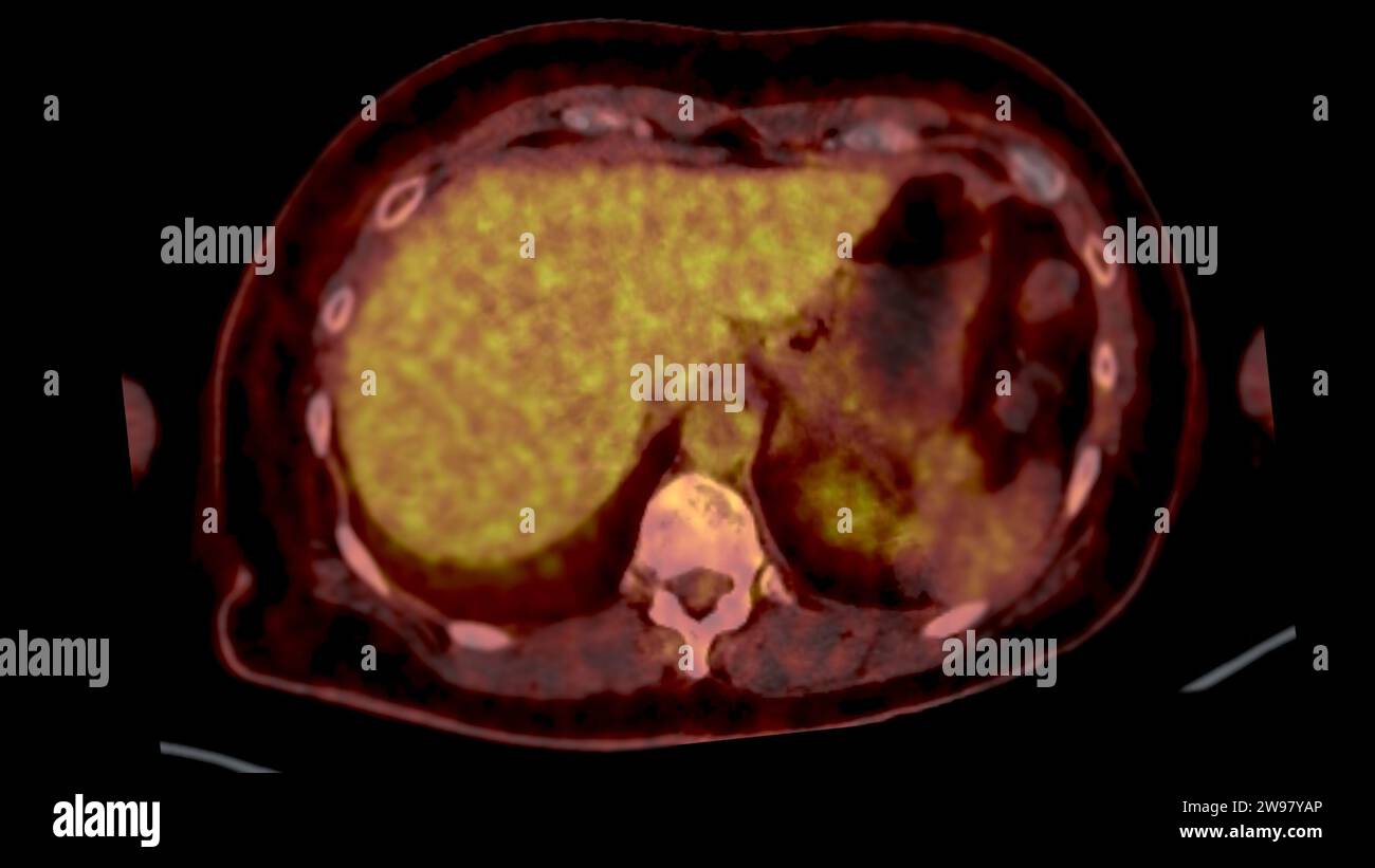 PET CT Scan fusion image It provides detailed images by merging ...