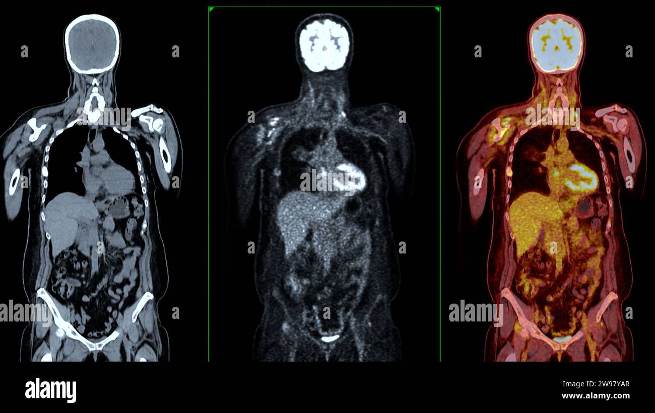 PET CT Scan fusion image It provides detailed images by merging ...