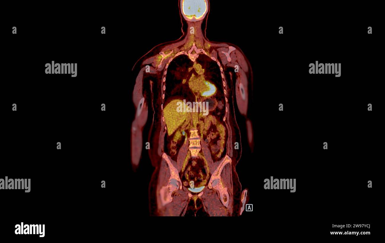 PET CT Scan fusion image It provides detailed images by merging ...