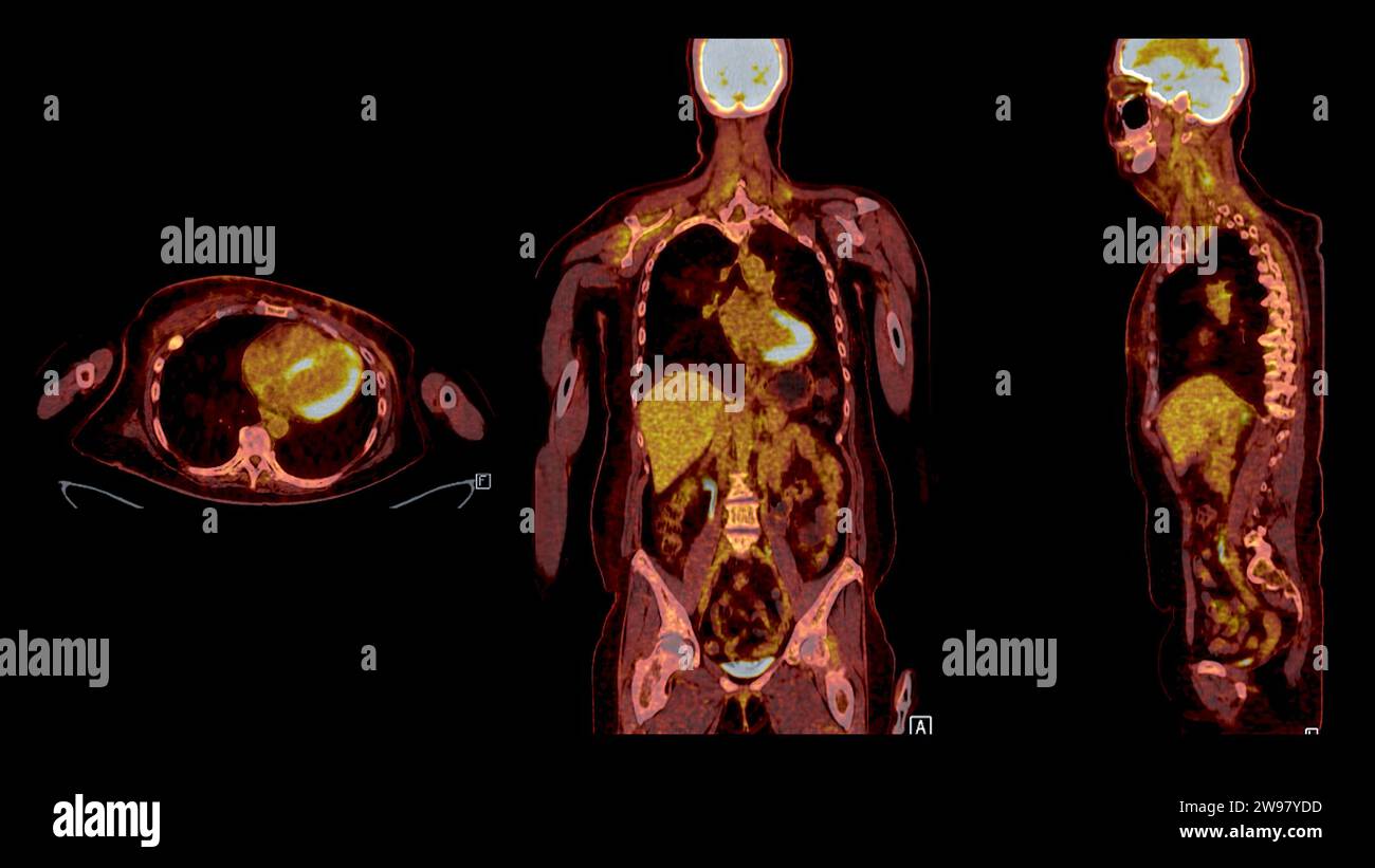 PET CT Scan fusion image It provides detailed images by merging ...