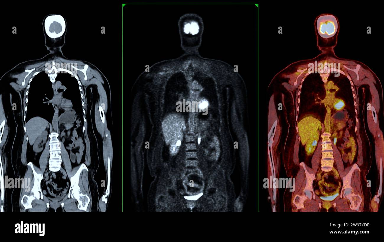 PET CT Scan fusion image It provides detailed images by merging ...