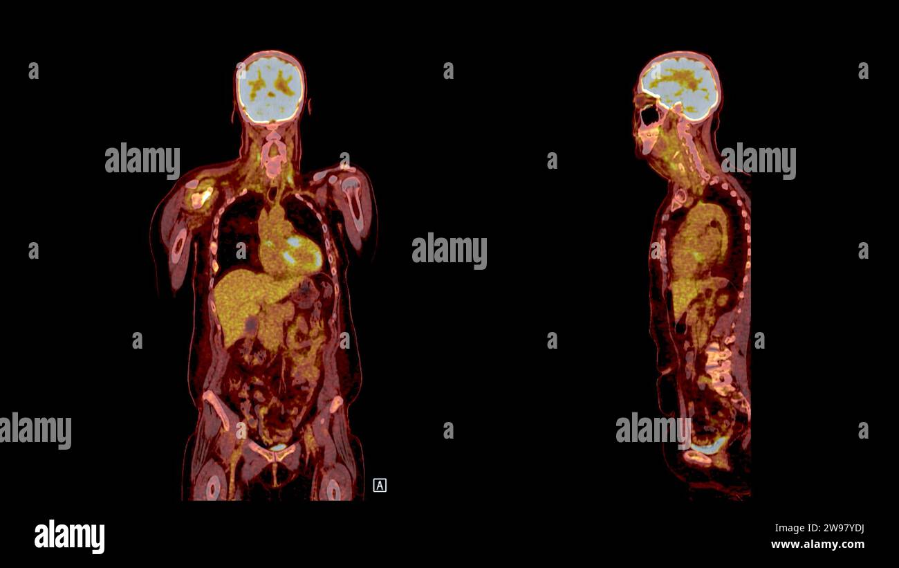 PET CT Scan fusion image It provides detailed images by merging ...