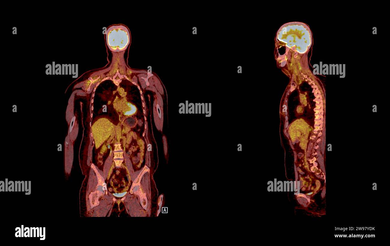 PET CT Scan fusion image It provides detailed images by merging ...