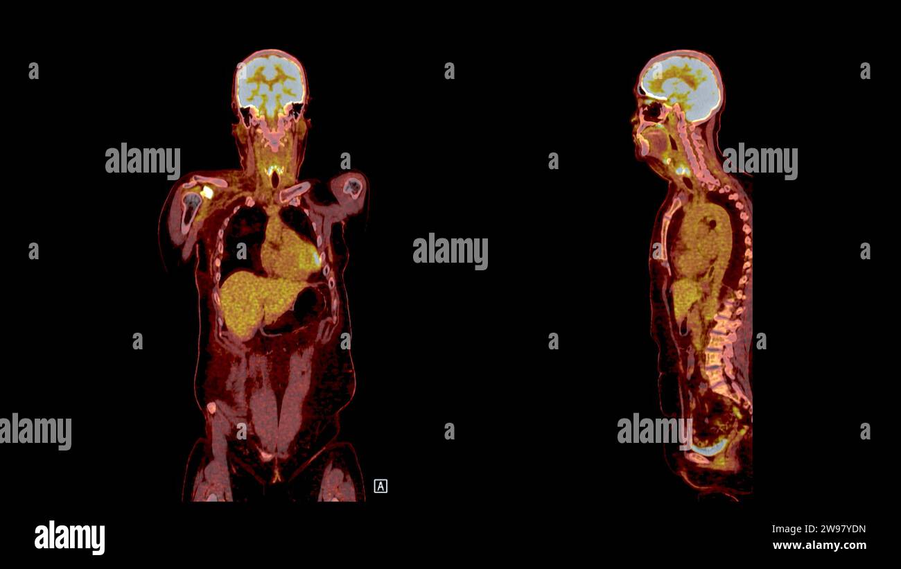 PET CT Scan fusion image It provides detailed images by merging ...