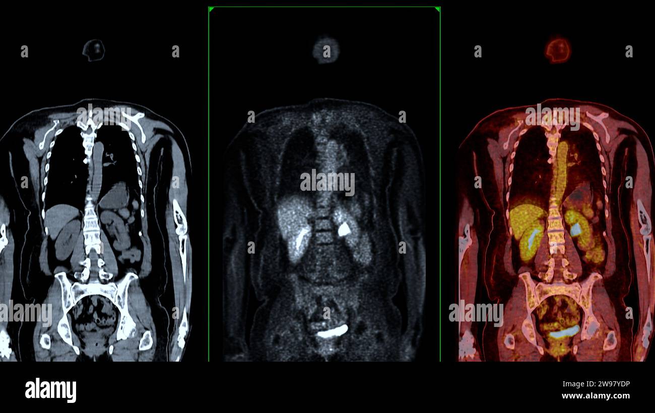 PET CT Scan fusion image It provides detailed images by merging ...