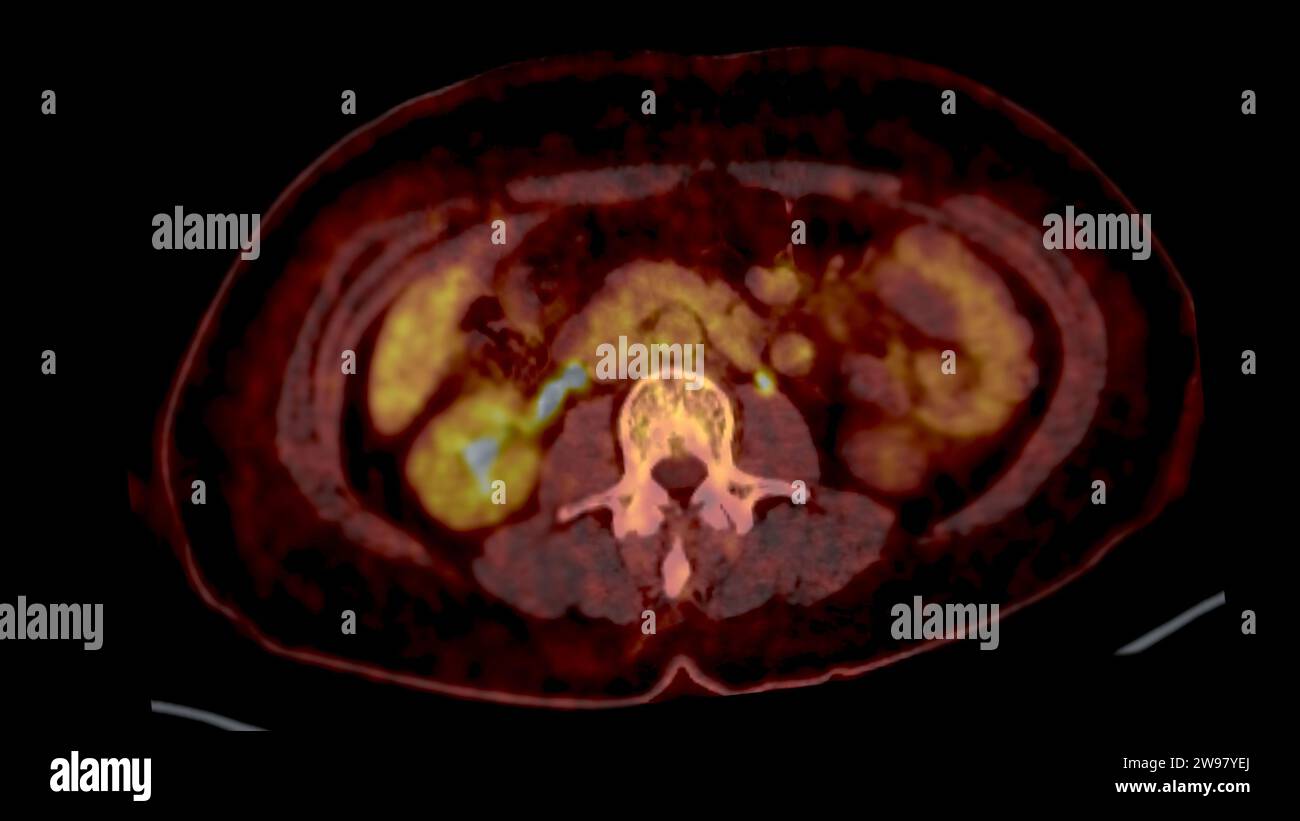 PET CT Scan fusion image It provides detailed images by merging ...
