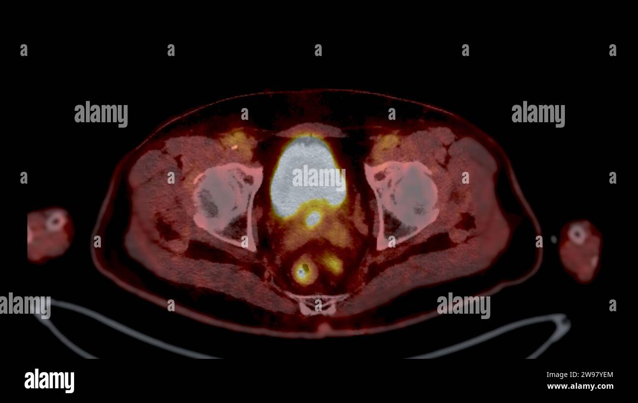 PET CT Scan fusion image It provides detailed images by merging ...