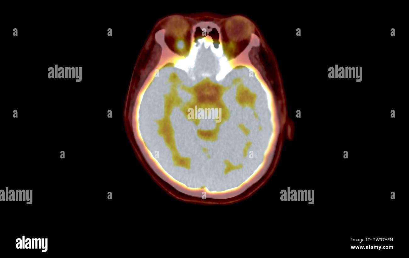 PET CT Scan fusion image It provides detailed images by merging ...