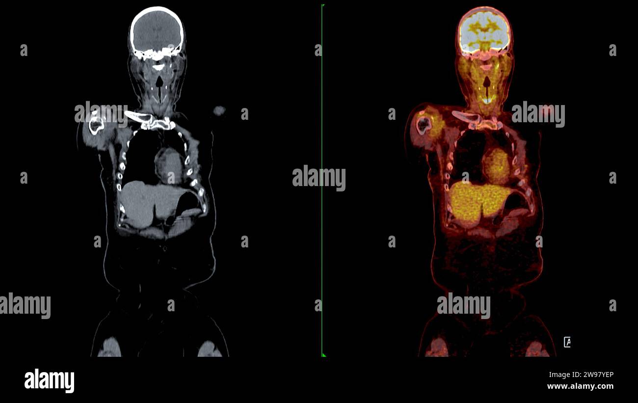 PET CT Scan fusion image It provides detailed images by merging ...