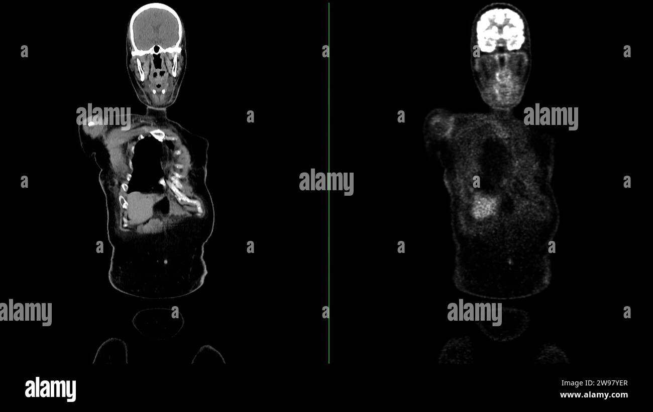 PET CT Scan fusion image It provides detailed images by merging ...