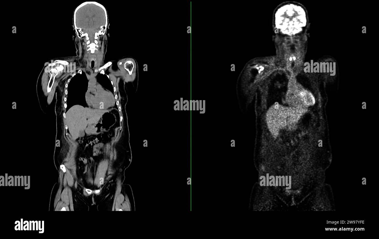 PET CT Scan fusion image It provides detailed images by merging ...