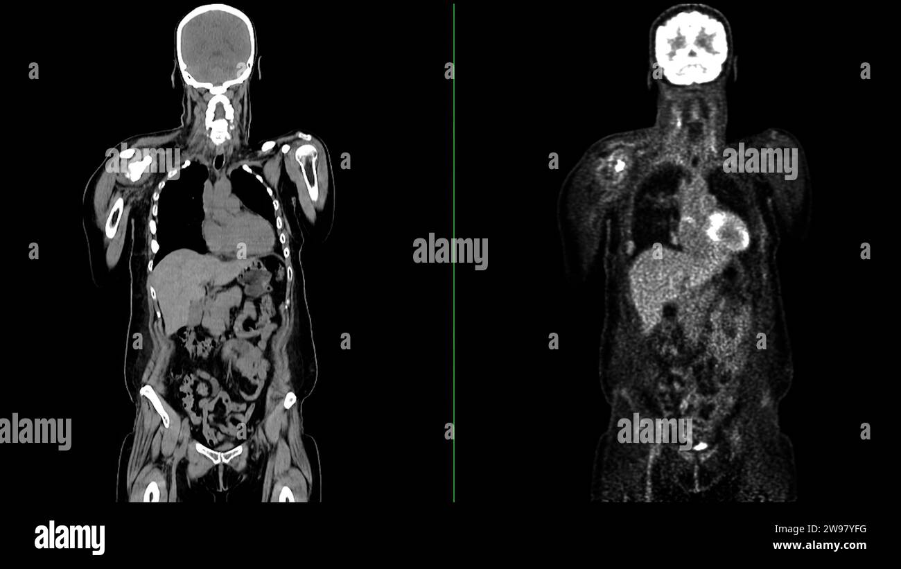 PET CT Scan fusion image It provides detailed images by merging ...