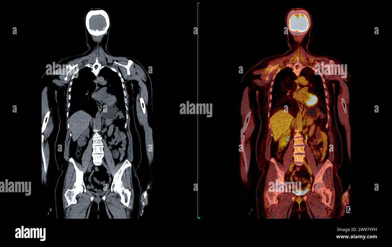 PET CT Scan fusion image It provides detailed images by merging ...