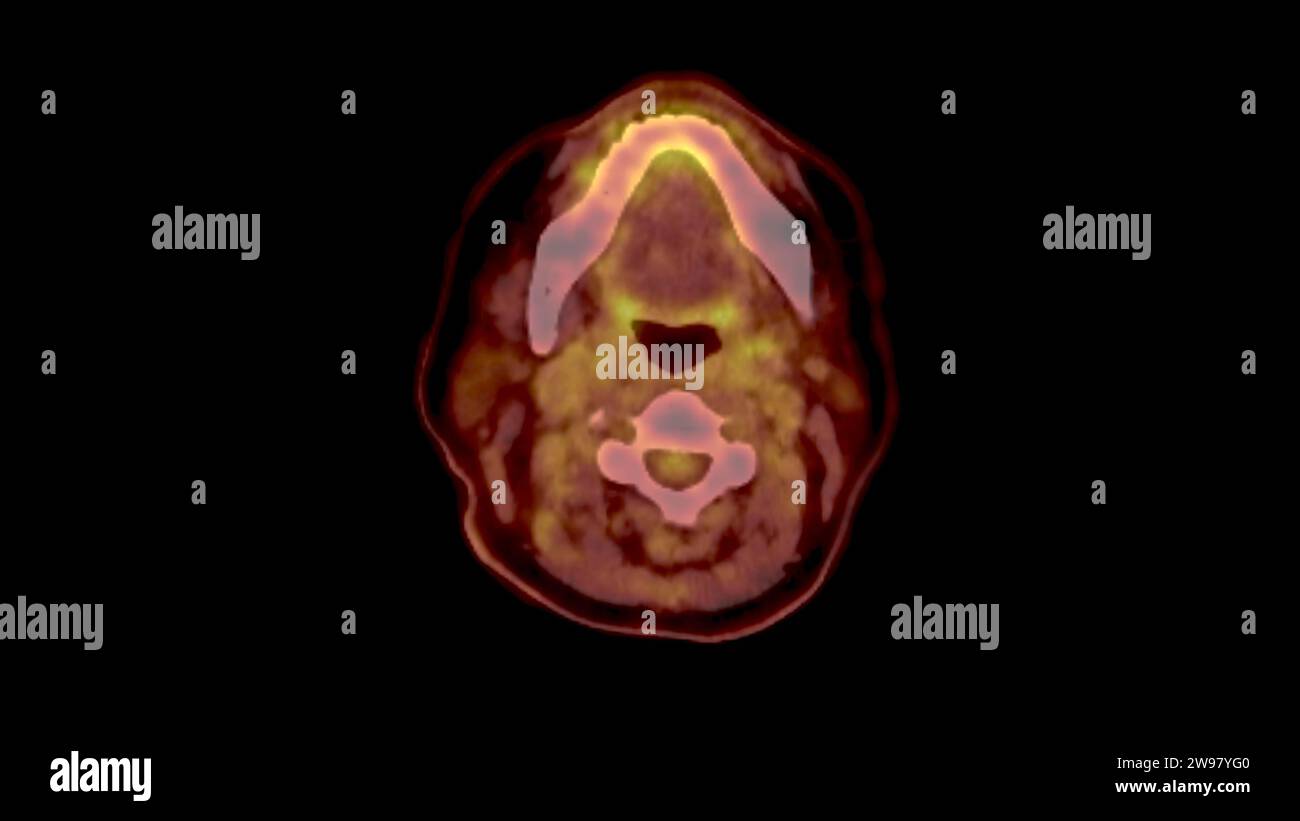 PET CT Scan fusion image It provides detailed images by merging ...