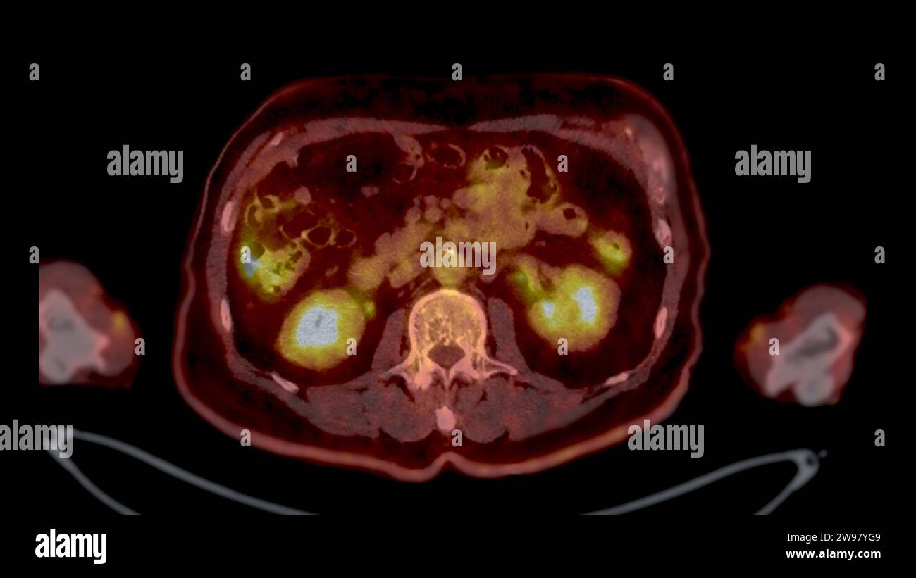 PET CT Scan fusion image It provides detailed images by merging ...