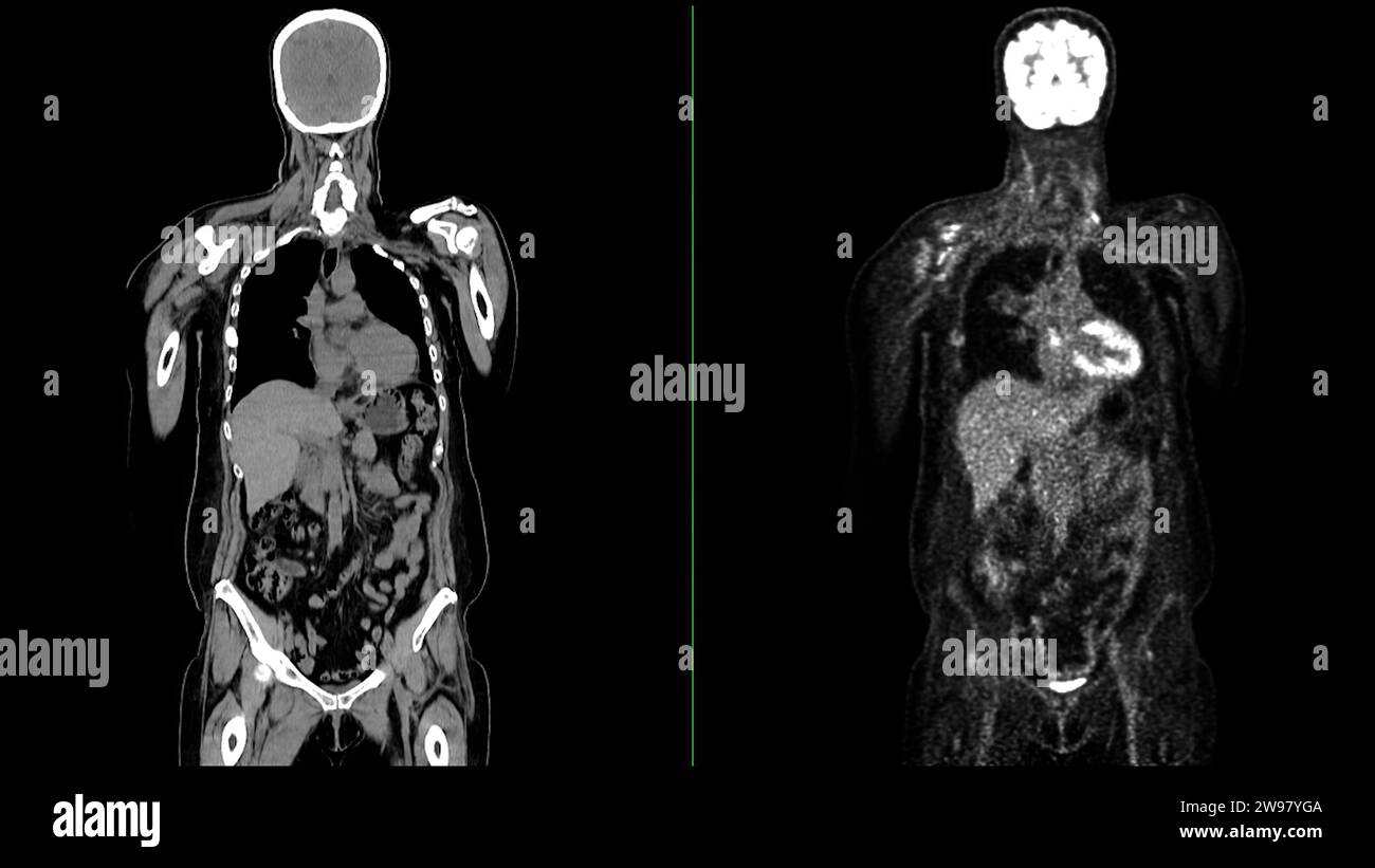PET CT Scan fusion image It provides detailed images by merging ...