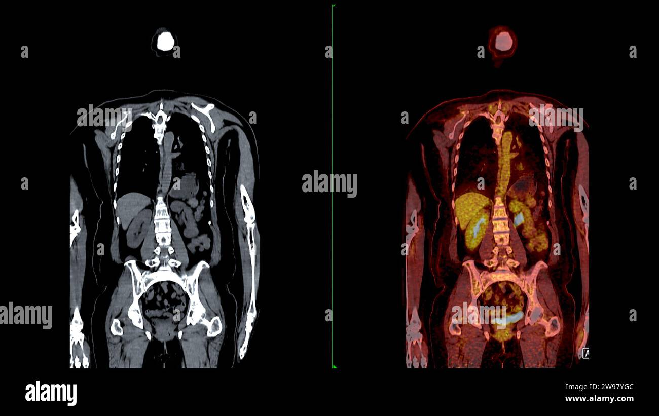 PET CT Scan fusion image It provides detailed images by merging ...