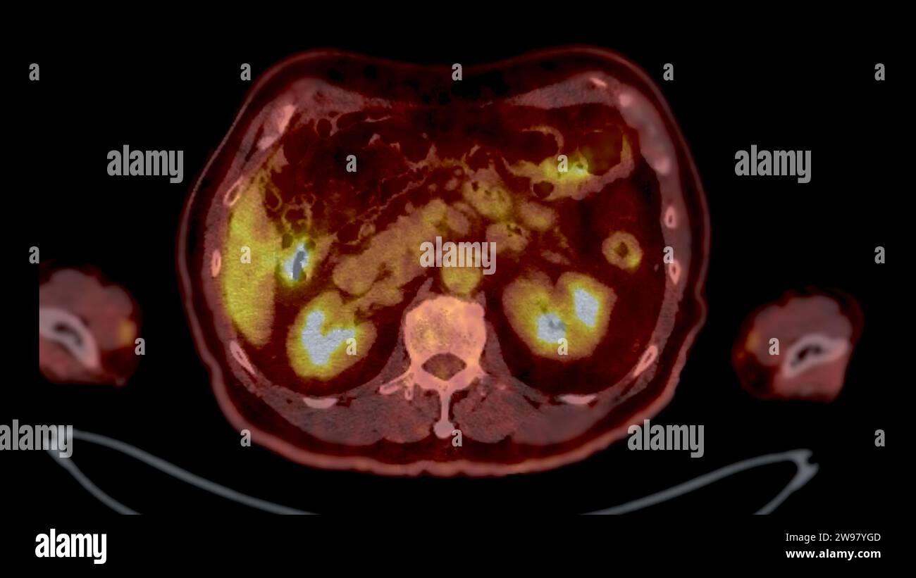 PET CT Scan fusion image It provides detailed images by merging ...