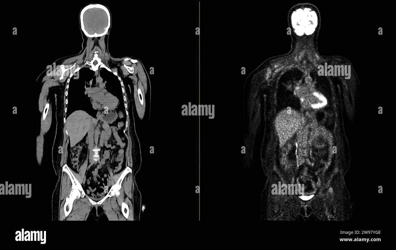 PET CT Scan fusion image It provides detailed images by merging ...