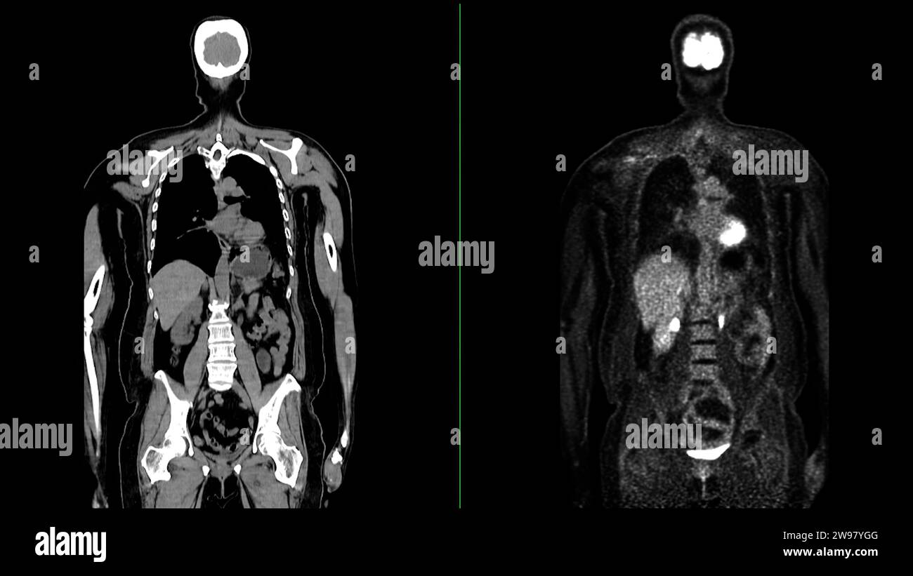 PET CT Scan fusion image It provides detailed images by merging ...
