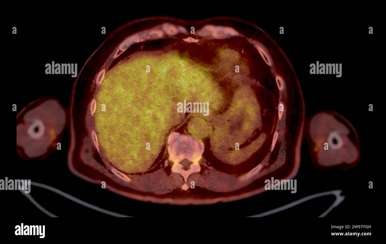 PET CT Scan fusion image It provides detailed images by merging ...