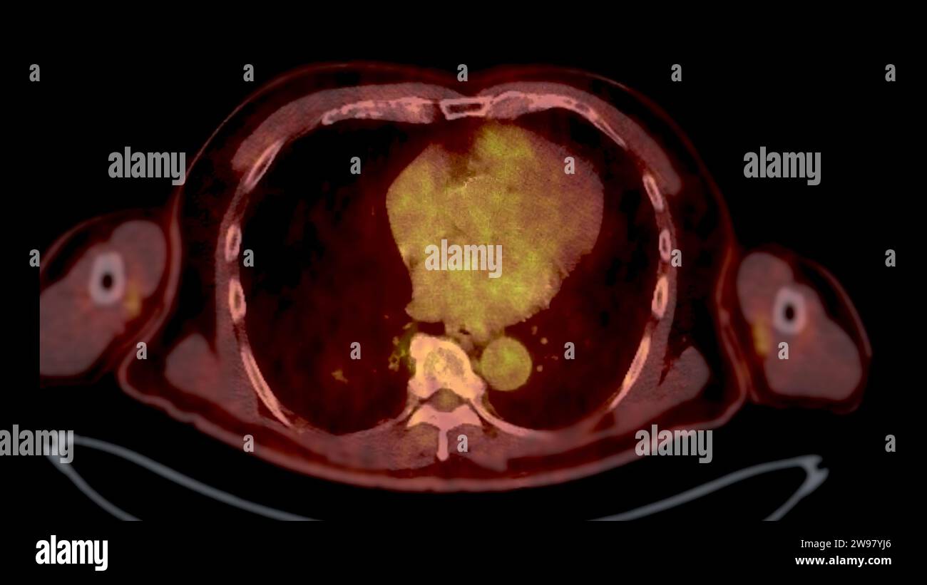 PET CT Scan fusion image It provides detailed images by merging ...