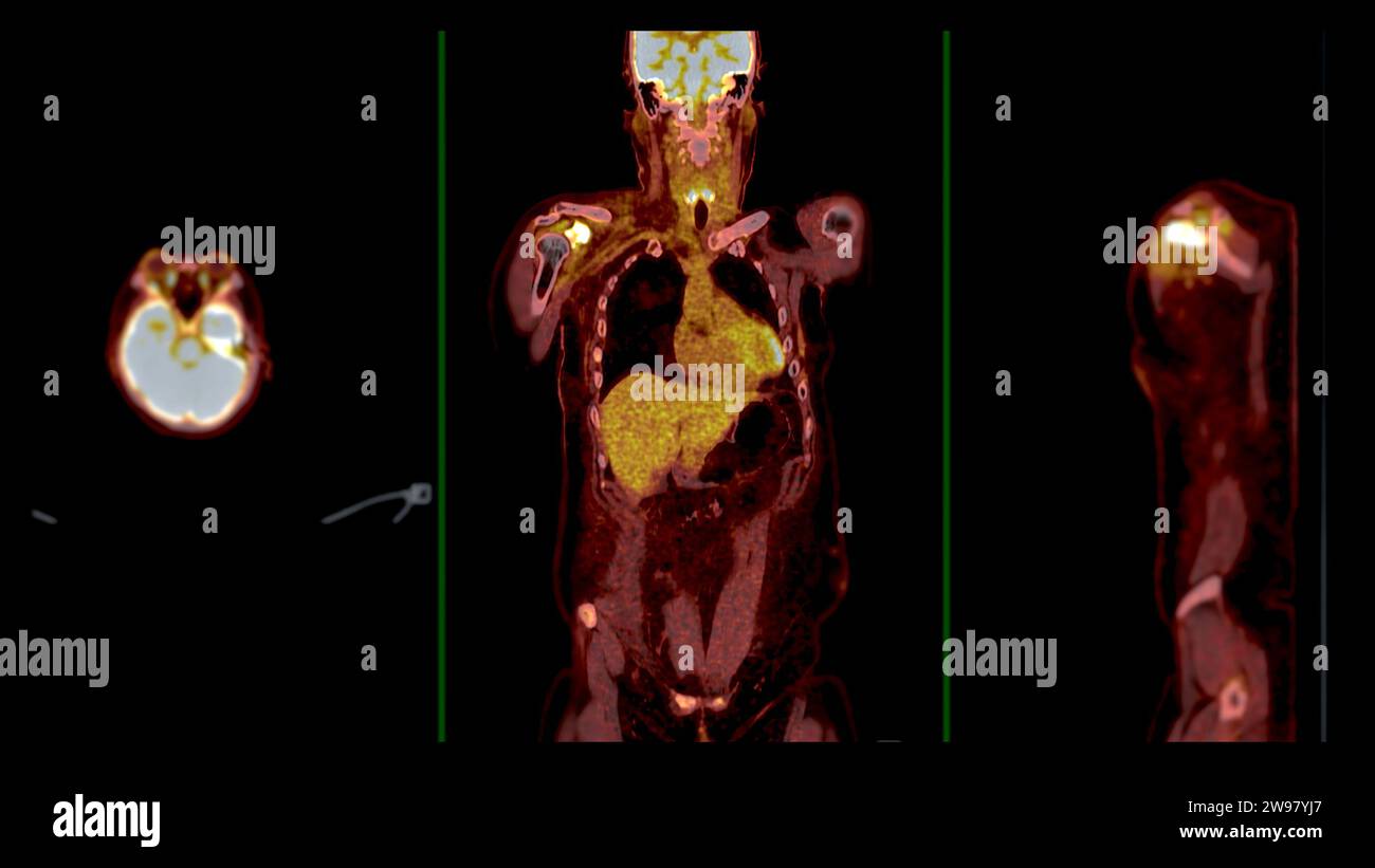 PET CT Scan fusion image It provides detailed images by merging ...