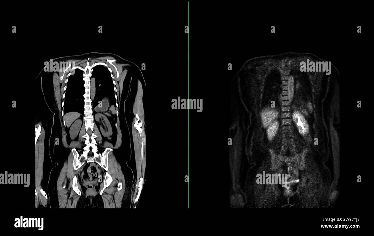 PET CT Scan fusion image It provides detailed images by merging ...