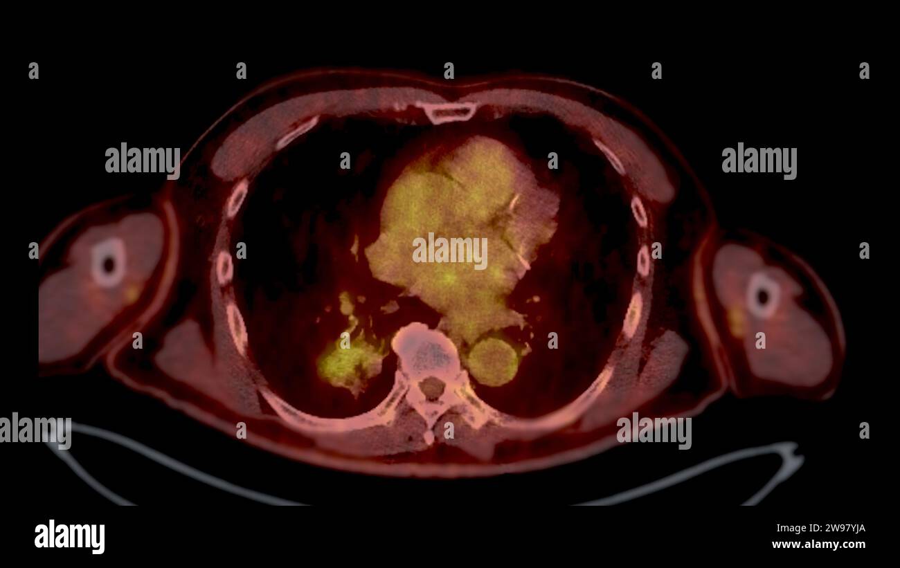 PET CT Scan fusion image It provides detailed images by merging ...