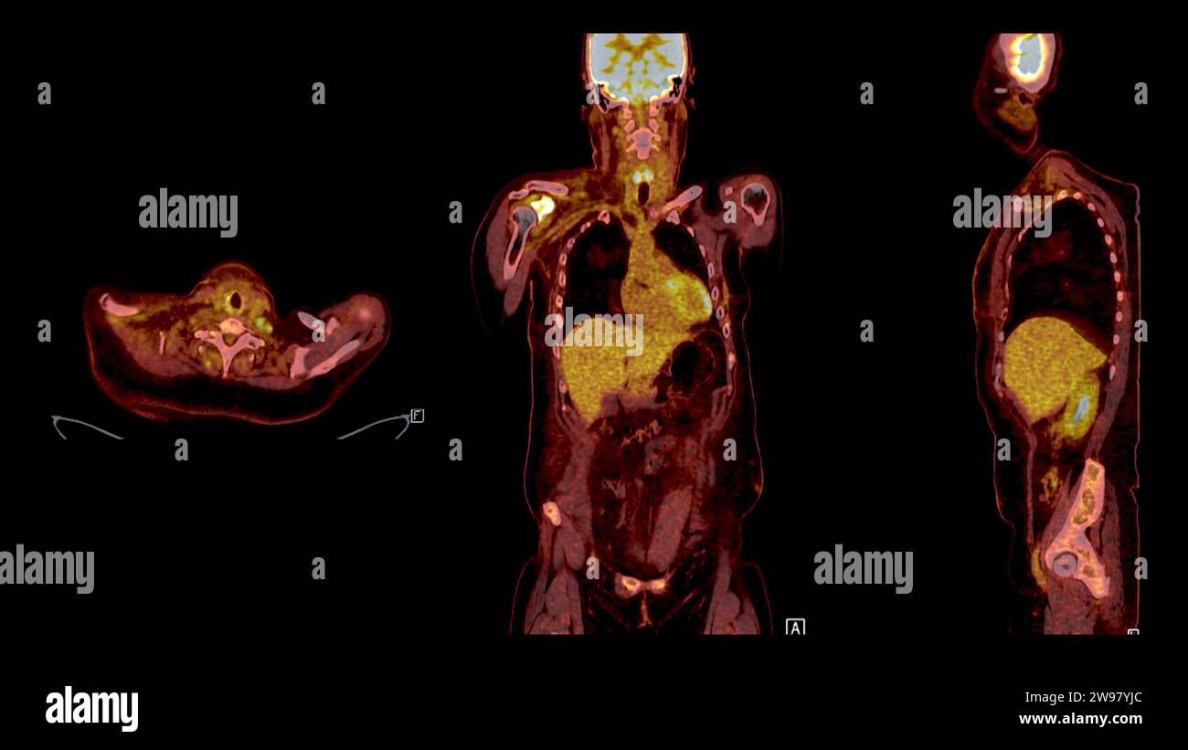 PET CT Scan fusion image It provides detailed images by merging ...