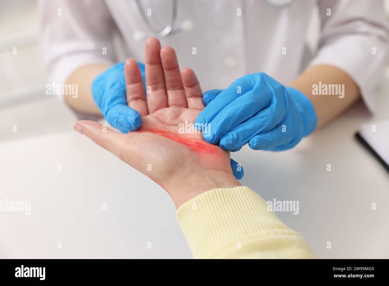 Doctor examining patient's burned hand indoors, closeup Stock Photo - Alamy