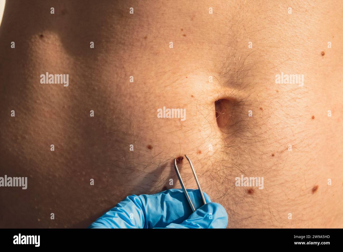 Doctor in medical gloves examining man skin mole for size ...