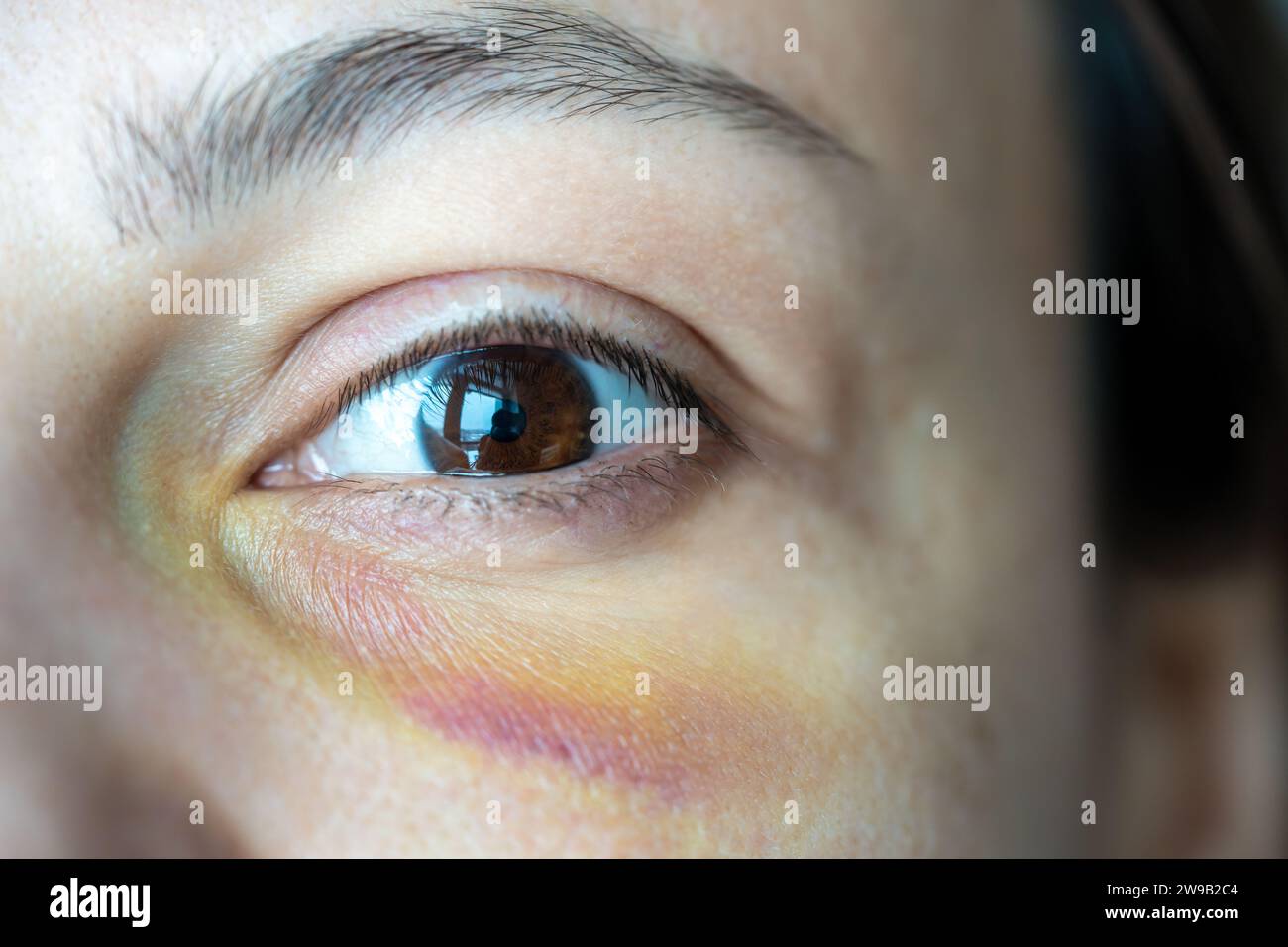 Close-up eye bruise hematoma of young woman suffered from domestic ...