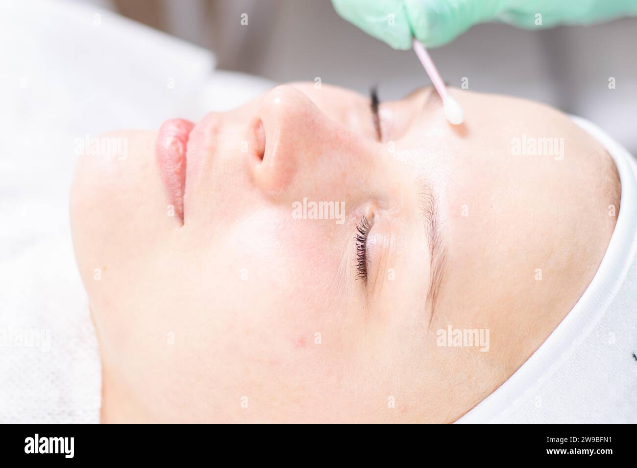 Portrait of a woman's face with problem skin. Peeling procedure ...