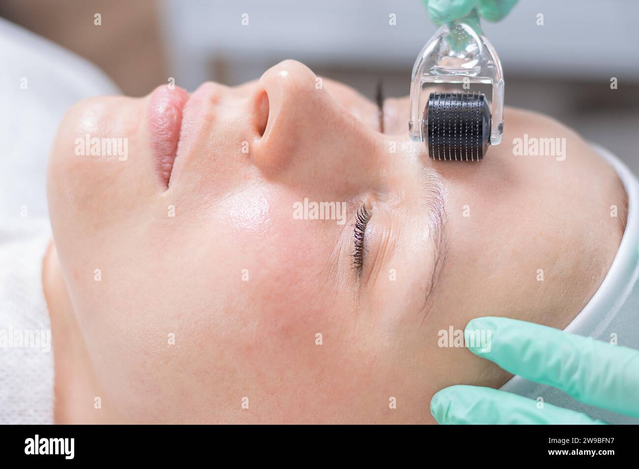 Portrait of a woman's face with problem skin. Peeling procedure ...