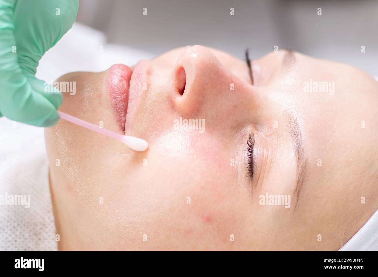 Portrait of a woman's face with problem skin. Peeling procedure ...
