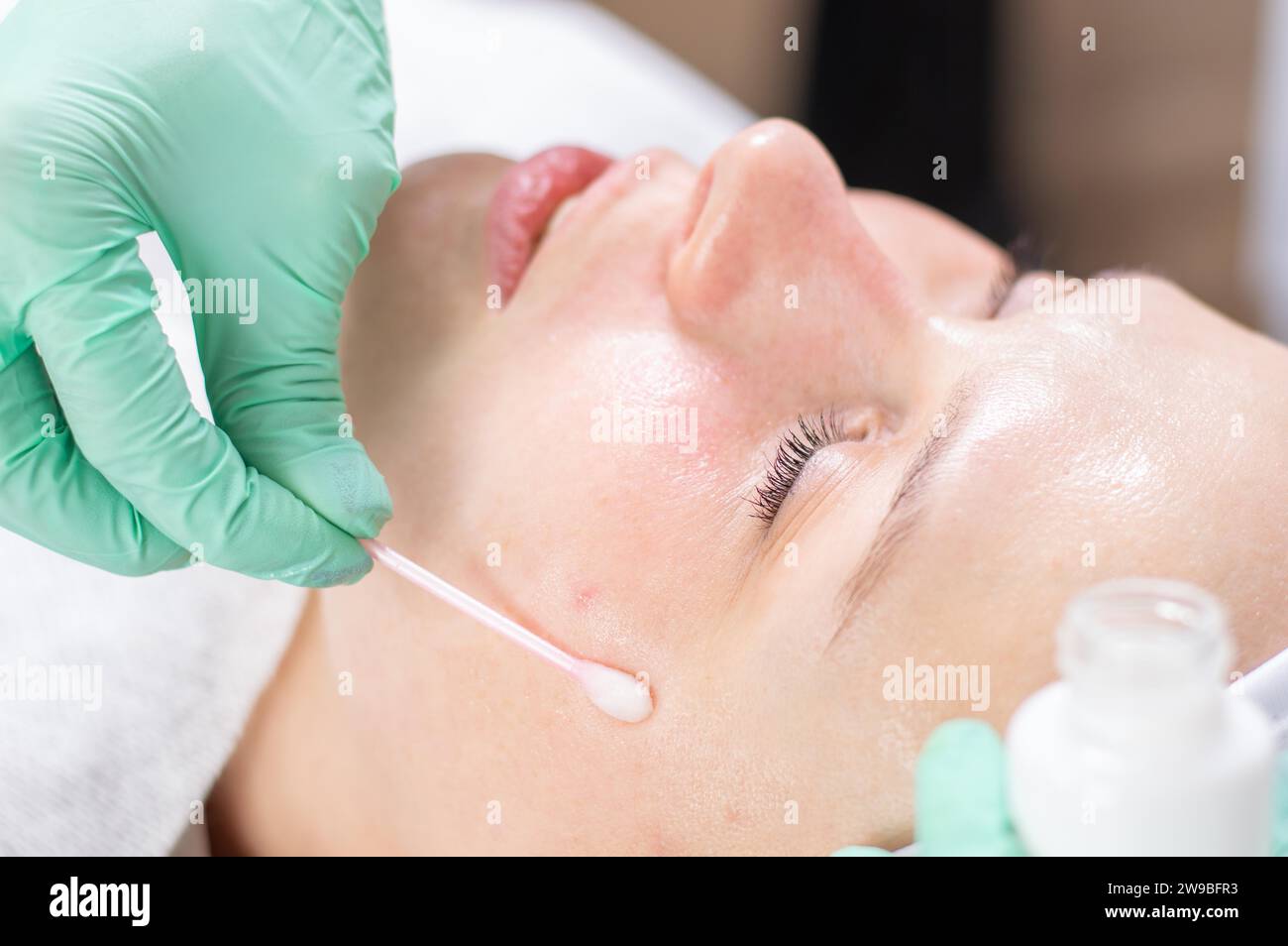Portrait of a woman's face with problem skin. Peeling procedure ...