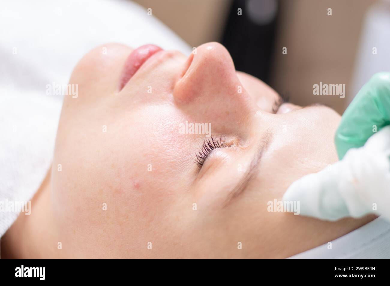 Portrait of a woman's face with problem skin. Peeling procedure ...