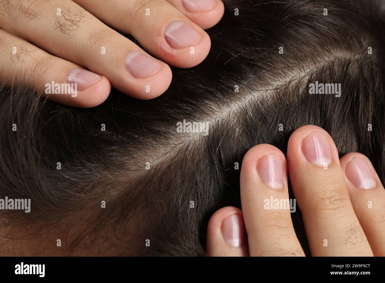 Man examining his head, closeup. Dandruff problem Stock Photo - Alamy