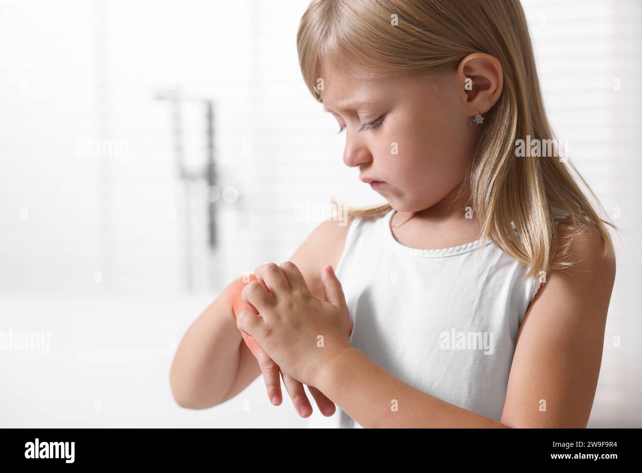 Suffering from allergy. Little girl scratching her hand indoors, space ...